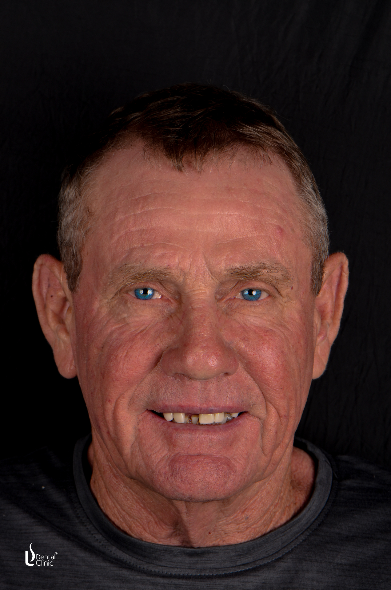 LS Dental Costa Rica | Dental Implants & Veneers